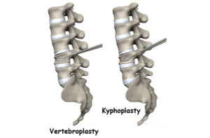 Kyphoplasty/Vertebroplasty - Dr. Mohammed Faizan | Indian Spine Clinic